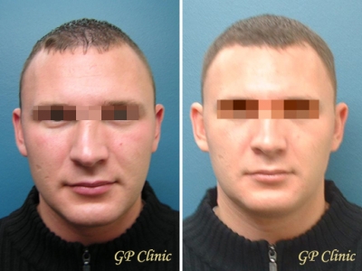 Septorhinoplasty Procedure, Uses & Recovery - Deviated Septum ...